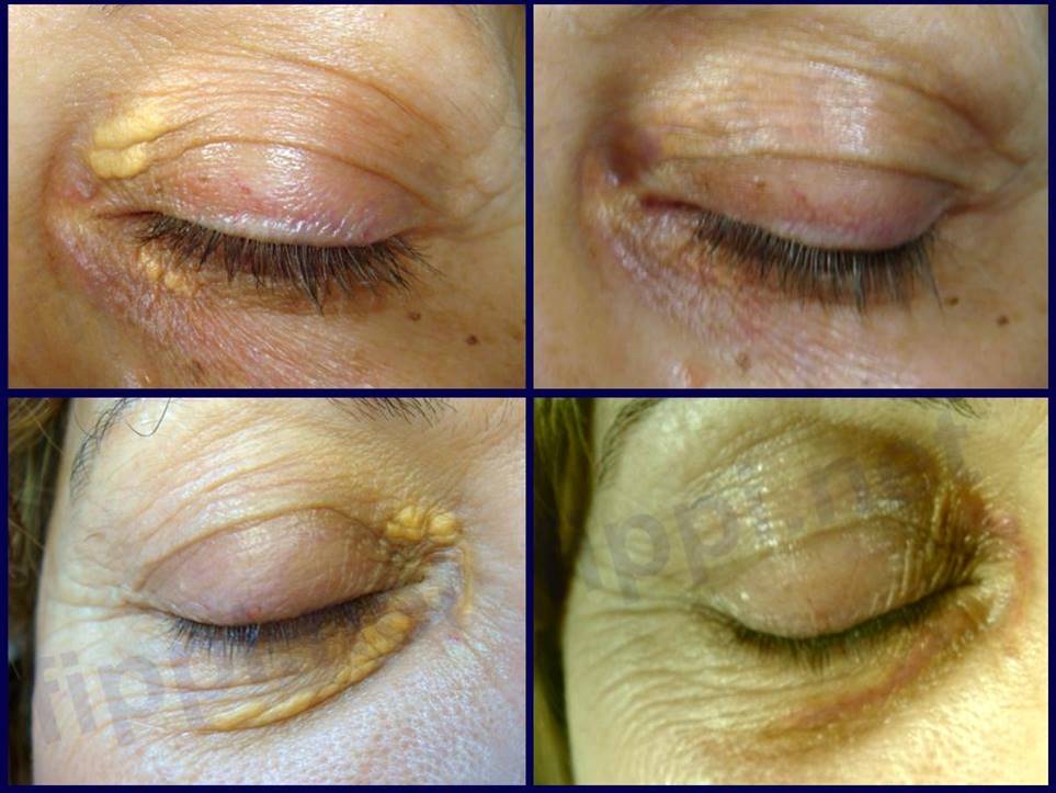 Xantelasmi palpebrali – Metodo Fippi: Dottor Vincenzo Crapanzano