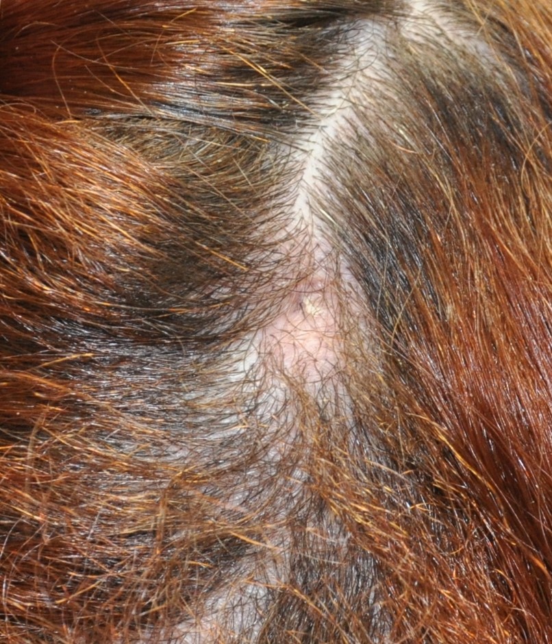 Cisti Sebacee: tecnica di rimozione mini invasiva – Metodo Fippi ...